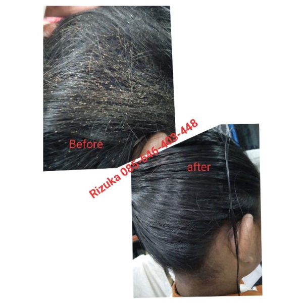 Jual paket obat kutu dan telur kutu rambut | Shopee Indonesia