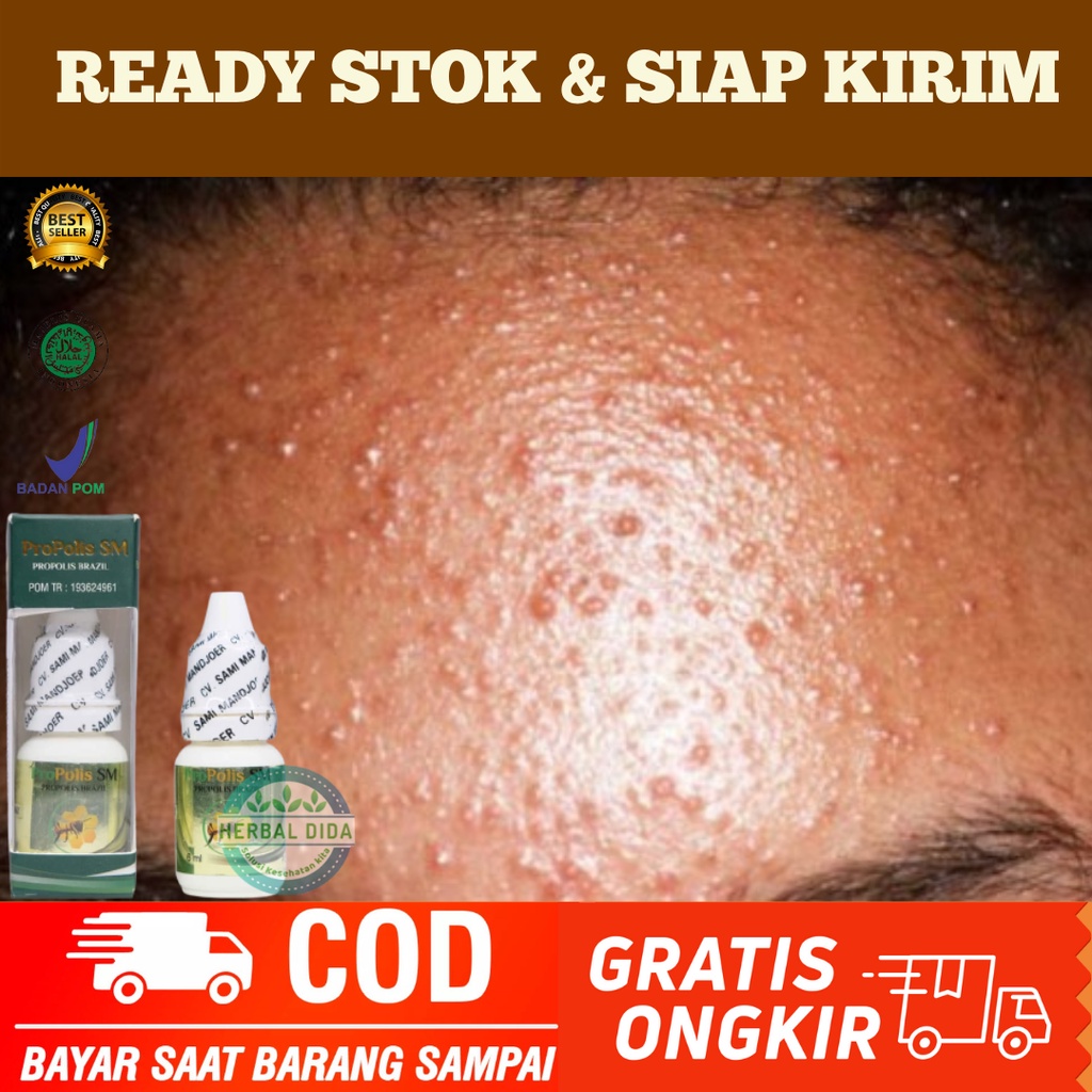Jual Obat oles Penghilang Bruntusan hitam Di Dahi, Obat Herbal ...