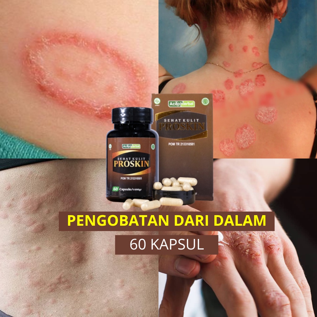 Jual PROSKIN obat gatal kulit Gatal Alergi Kulit Antibakteri Biduran ...