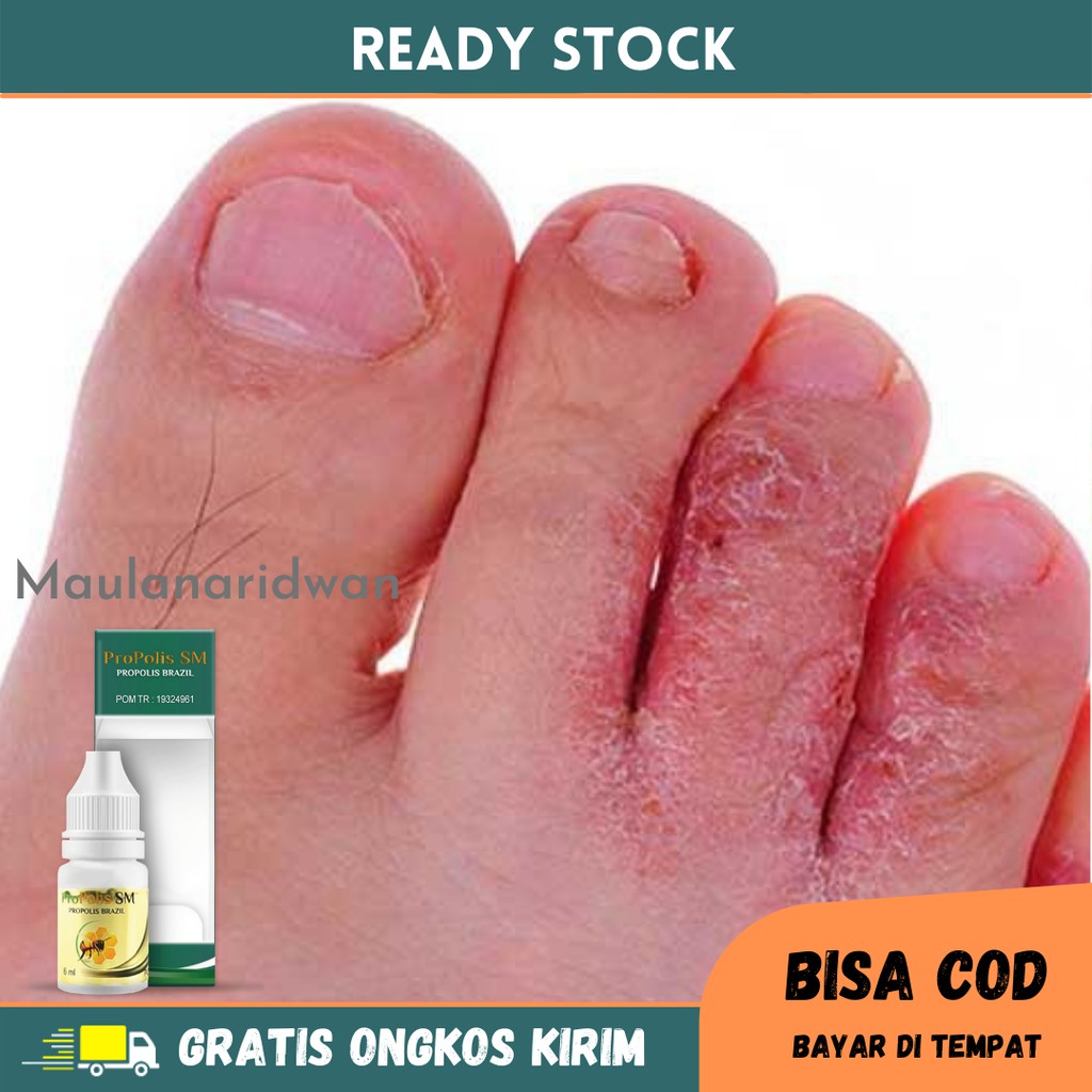 Jual Obat Kutu Air, Cacar Air, Tinea Pedas, Kulit Gatal Berair, Infeksi ...