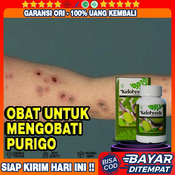 Jual Obat Prurigo - Obat Solusi Kulit Mudah Luka - Obat Gatel Kulit ...