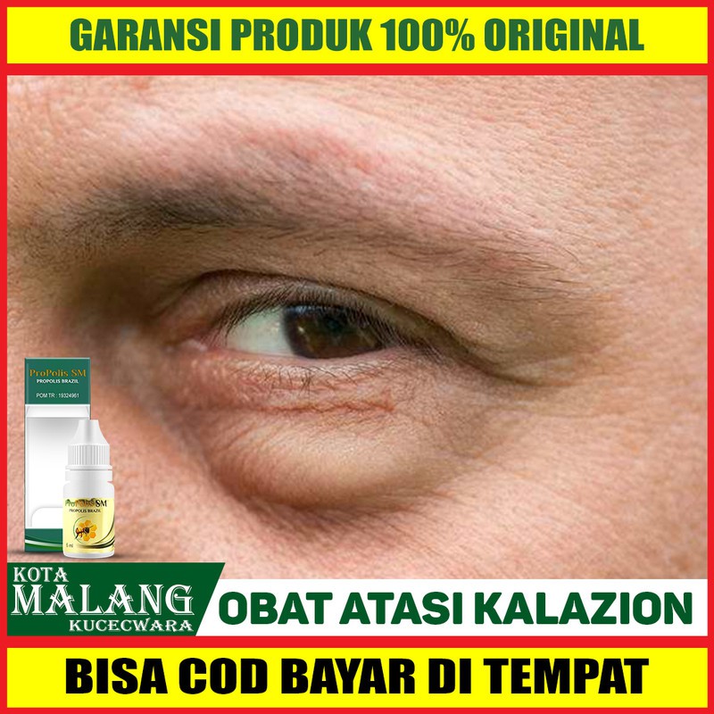 Jual Obat Kalazion, Mata Bintitan, Benjolan Kelopak Mata Herbal ...