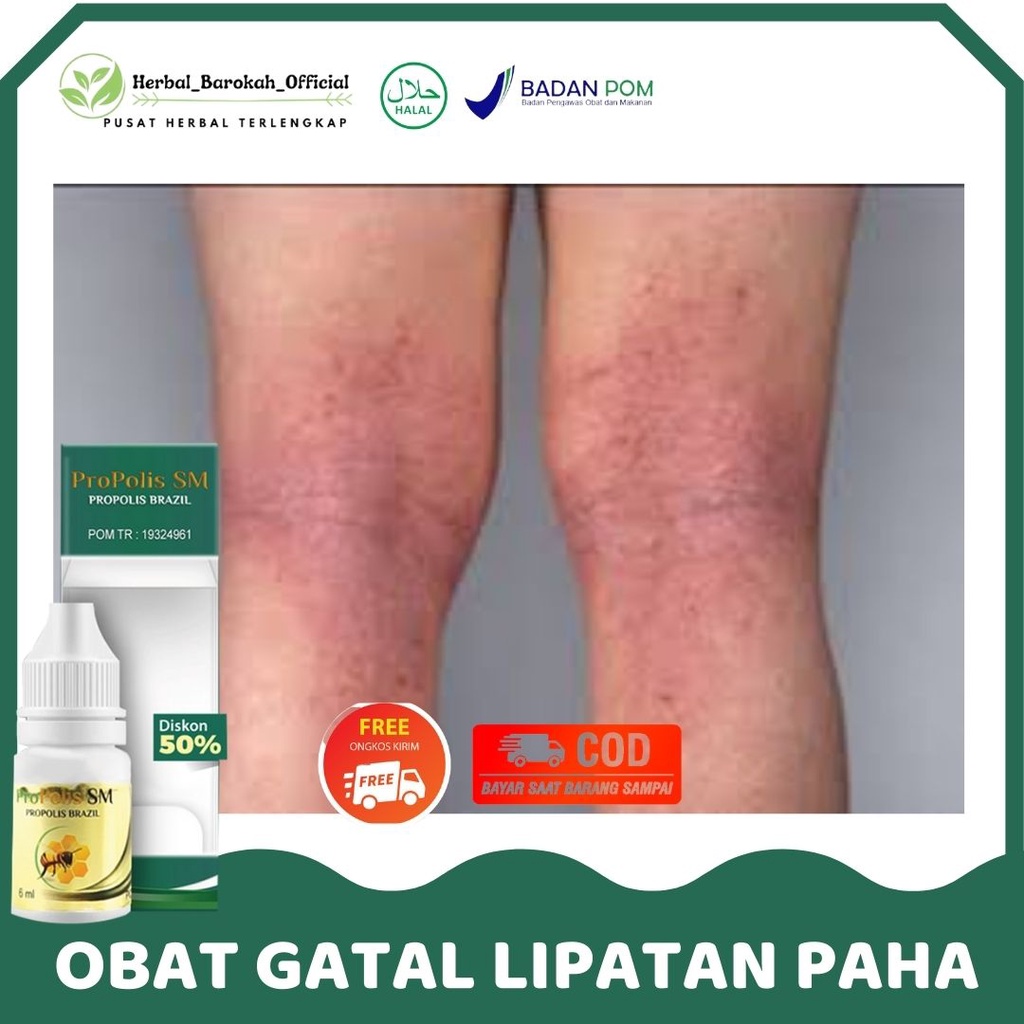 Jual Obat Oles Gatal Lipatan Paha , Bercak Merah Di Paha , Gatal Parah ...