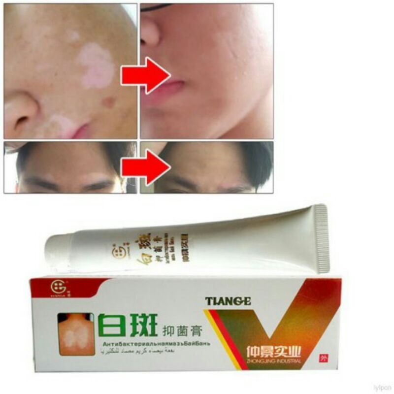 Jual viral salep herbal VITILIGO menghilangkan bercak putih pada kulit ...
