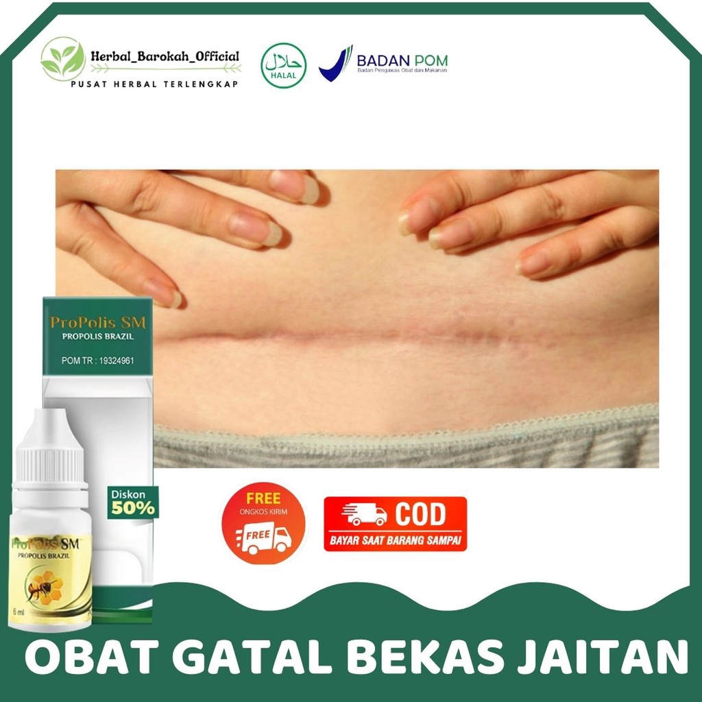 Jual Obat Gatal Bekas Jaitan , Jaitan Operasi Caesar , Pengering Luka ...