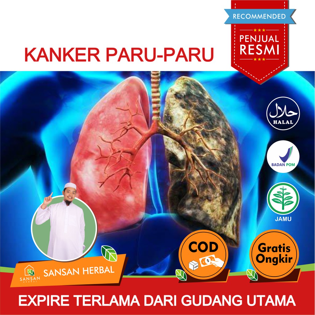Jual Solusi Untuk Obat Kanker Paru Paru, Flek Paru Paru, Radang Paru ...