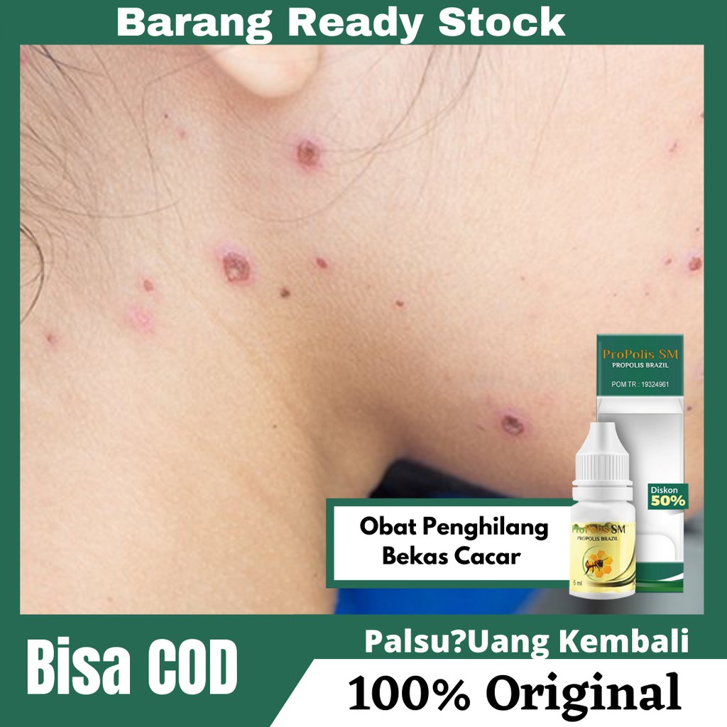 Jual Obat Penghilang Bekas Cacar , Bekas Luka Cacar Di Wajah , Kaki ...