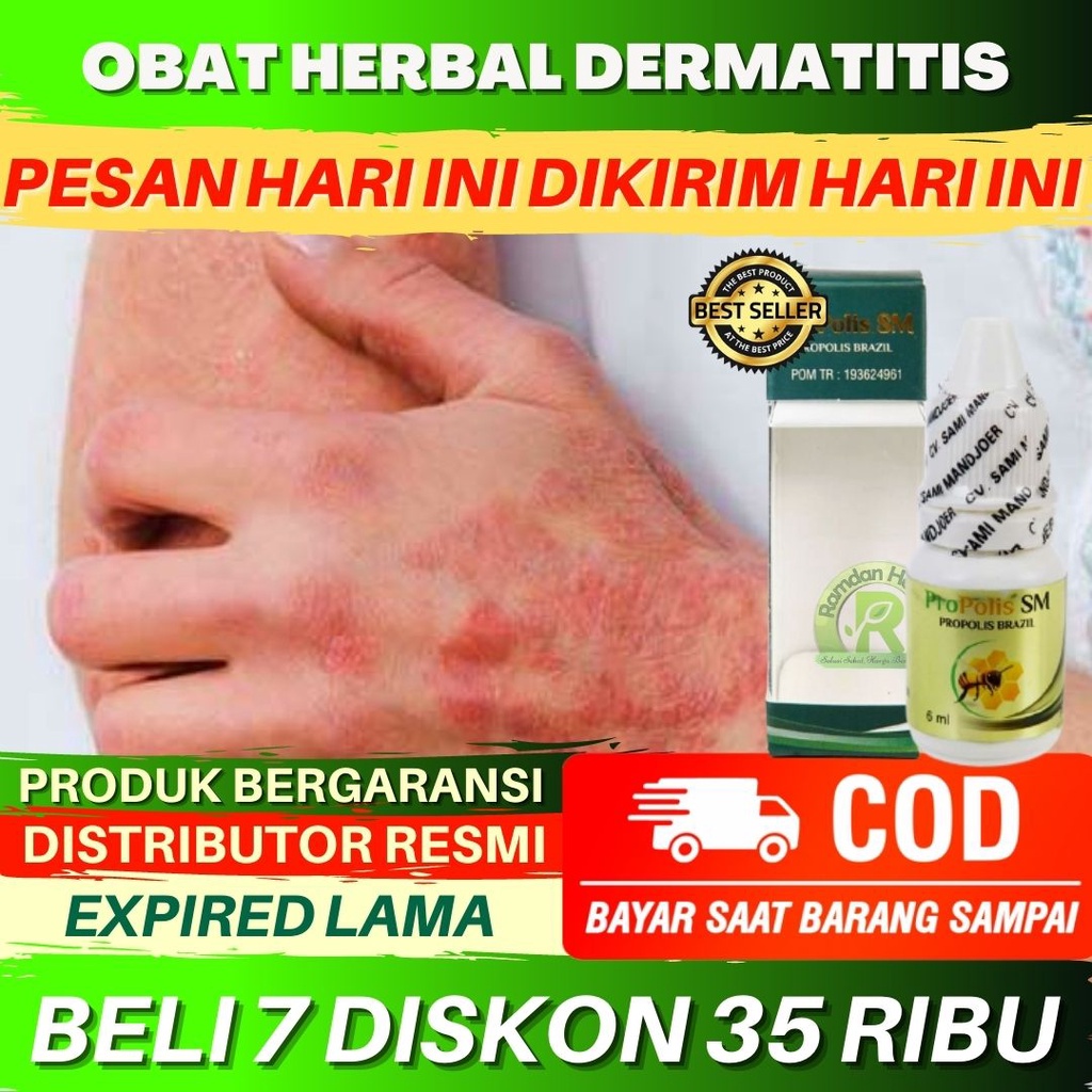 Jual Obat Dermatitis Kronis Dermatitis Seboroik Dermatitis Atopik Dermatitis Perioral Dermatitis ...