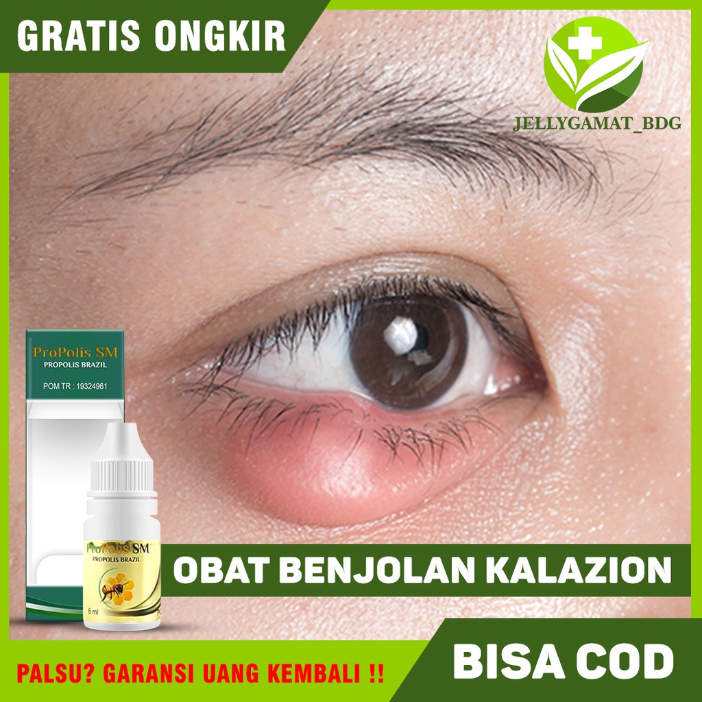 Jual Obat Kalazion, Benjolan Kelopak Mata, Mata Bintitan Herbal Asli ...