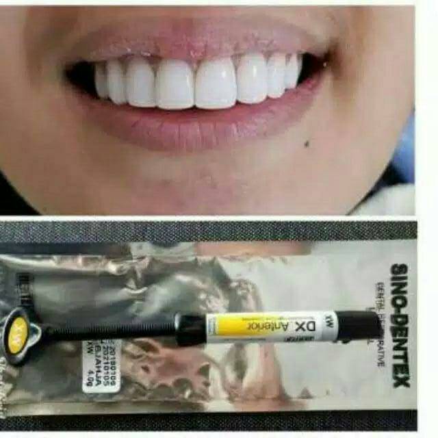 Jual Composite veneer denteX EXW extra white | Shopee Indonesia