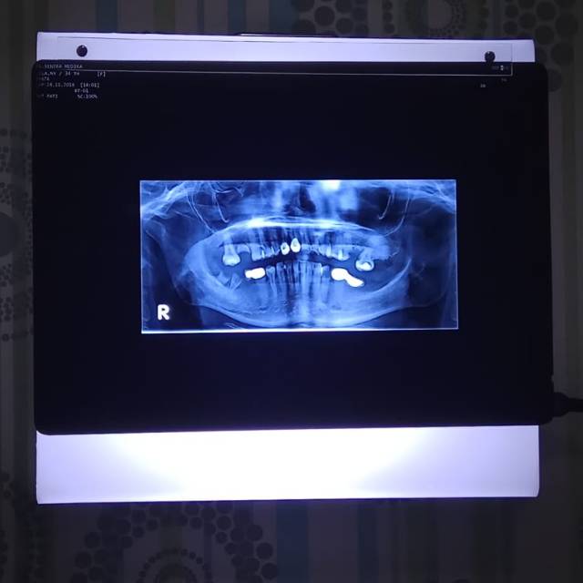 Jual RONTGEN VIEWER PORTABLE 35X32 | Shopee Indonesia