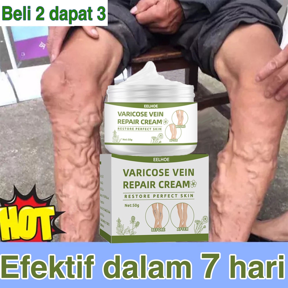 Jual Varises Cream Obat Varises Salep 30g Varicose Veins Varikokel ...