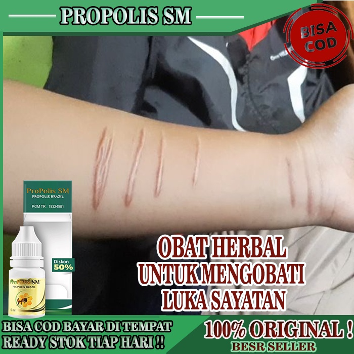 Jual Obat Penghilang Bekas Luka Sayatan, Obat Pengering Luka Sayatan ...