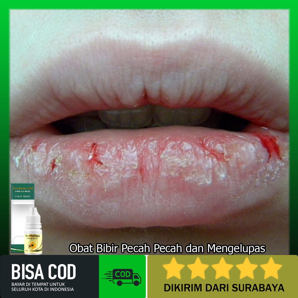 Jual Obat Bibir Pecah Pecah dan Mengelupas Karena Panas Dalam | Bibir ...