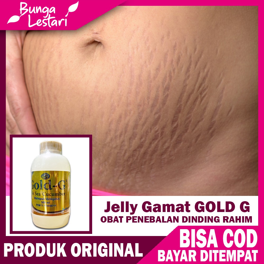 Jual Obat Penghilang Singkayo - Stretch Mark - Selulit Keloid Sembuh ...