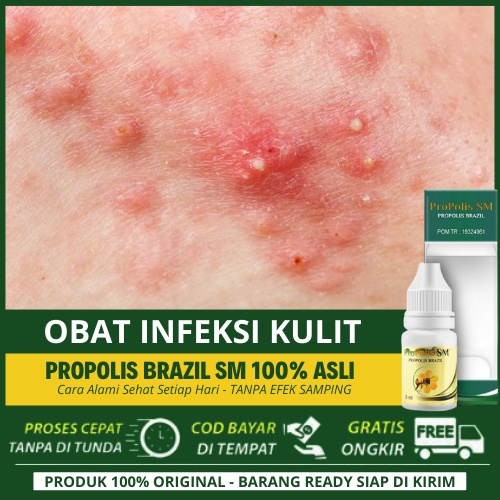 Jual Obat Infeksi Kulit Karena Bakteri Jamur Pada Anak Di Wajah&Kepala ...