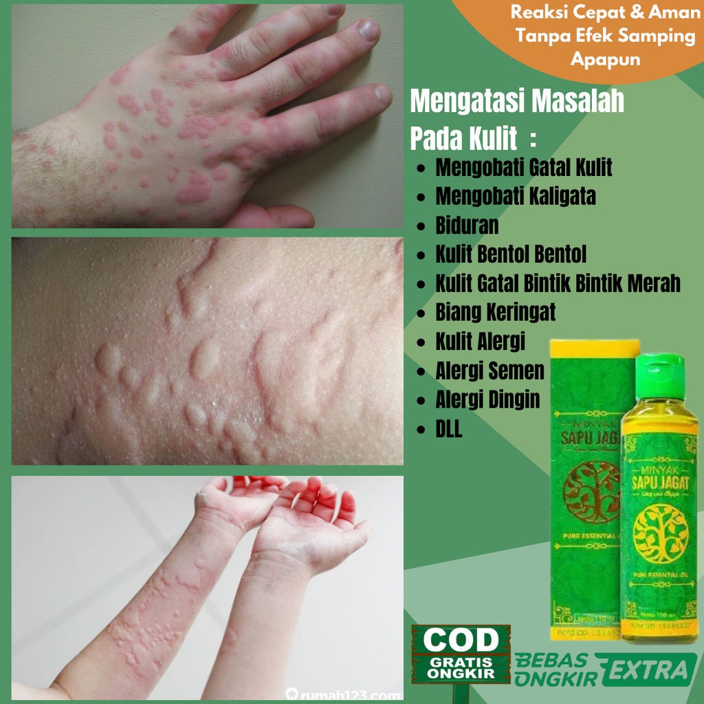 Jual Obat Oles Gatal Gatal - Gatal Kulit Seluruh Badan - Gatal Kulit ... Jual Obat Oles Gatal Gatal - Gatal Kulit Seluruh Badan - Gatal Kulit ...