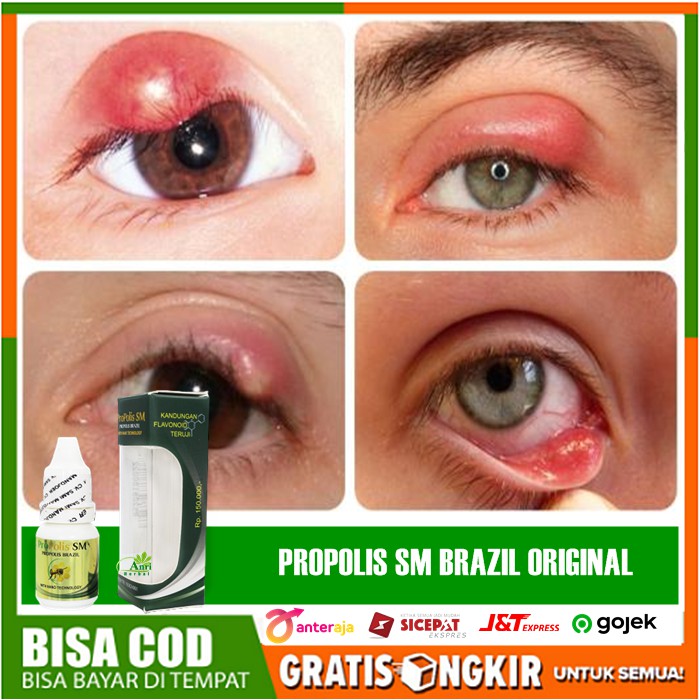 Jual Obat kalazion, benjolan di kelopak mata, kelopak mata bengkak ...