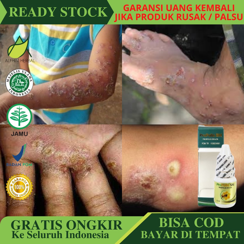 Jual Obat Tetes Budug Bernanah, Budug Di Tangan Dan Kaki, Obat Cenang ...