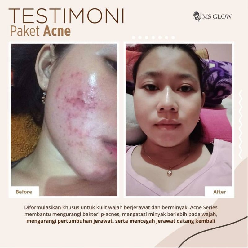 Jual Paket Acne Series | Shopee Indonesia