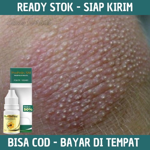Jual Obat Untuk Menghilangkan Keratosis Pilaris, Penyakit Kulit Ayam ...