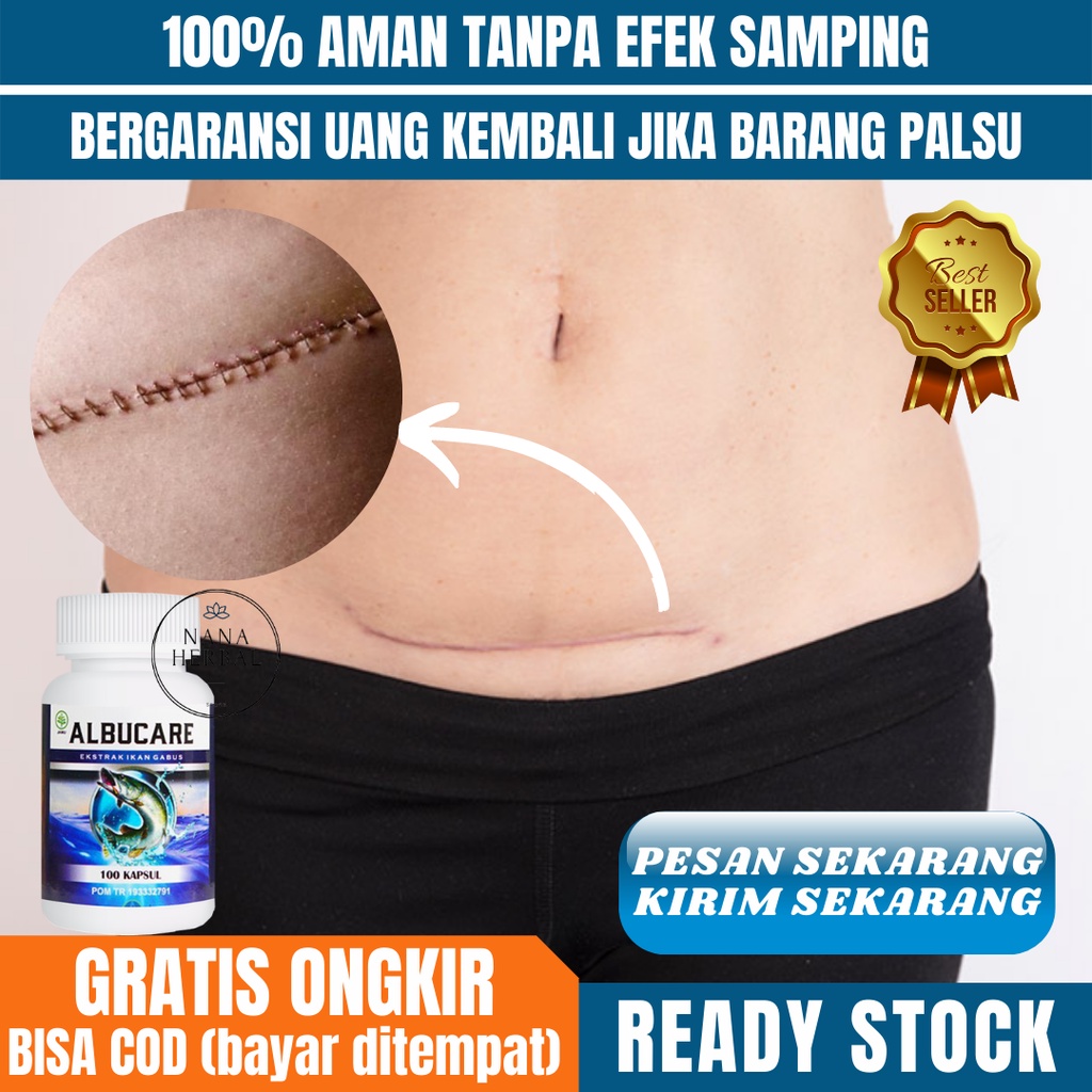Jual Obat Pengering Luka Bekas Operasi Caesar, Obat Luka Baru/Lama ...