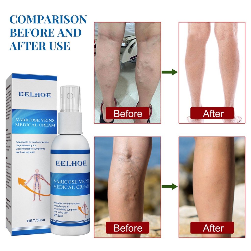 Jual Herbal Varicose Veins Treatment Spray Ubat Vena Varikos Phlebitis ...