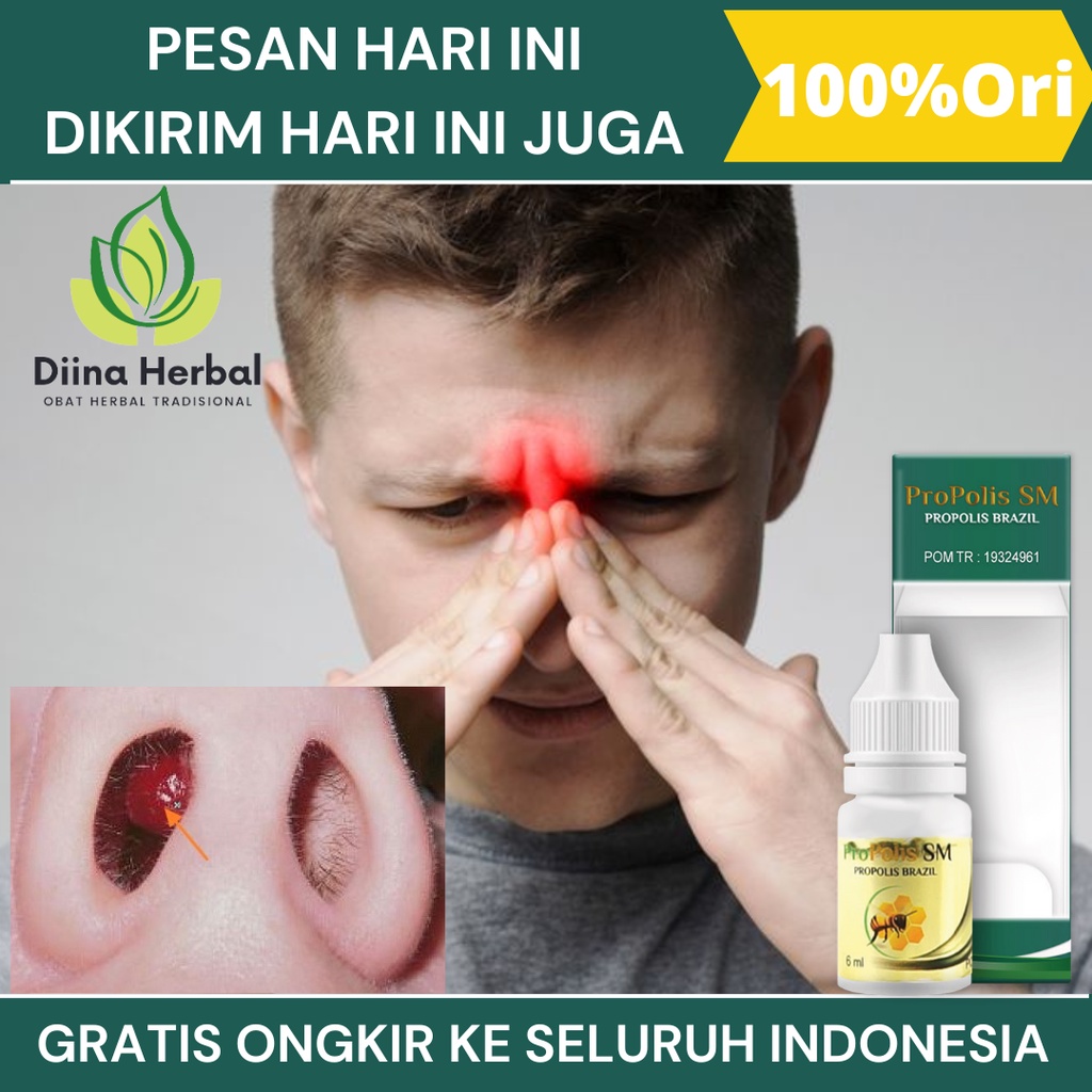 Jual Obat Polip Hidung, Obat Tetes Polip Hidung, Obat Benjolan Di ... Jual Obat Polip Hidung, Obat Tetes Polip Hidung, Obat Benjolan Di ...