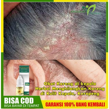 Jual Obat Koreng di kepala | Herbal Menghilangkan Koreng di Kulit ...