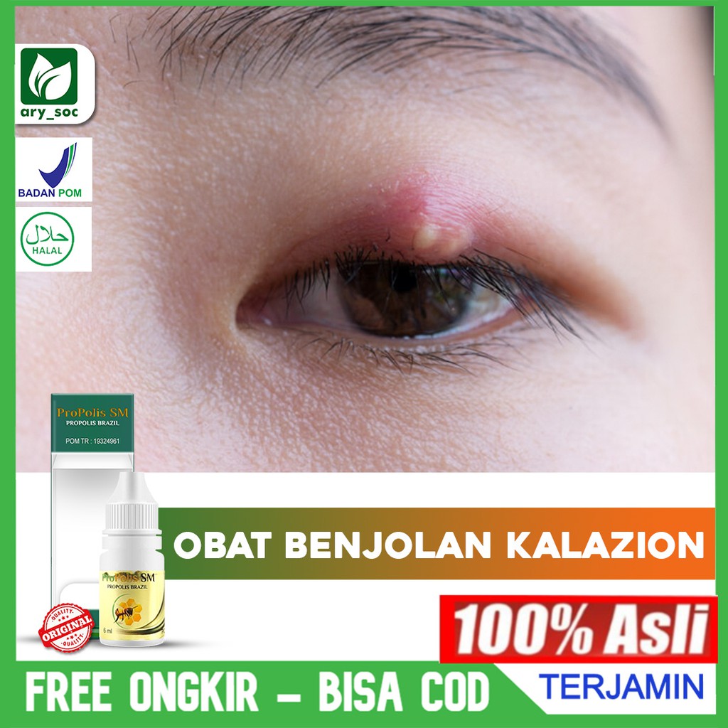 Jual Obat Kalazion - Sakit Mata Bintitan Menahun - Benjolan Kelopak ...