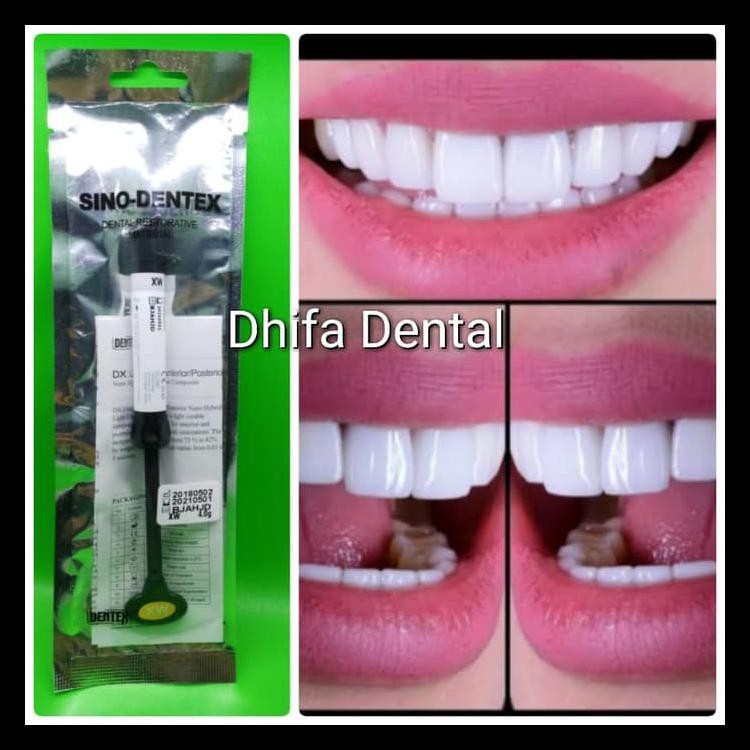 Jual Composite Dentex Anterior XW/ Use Veneer FREE ONGKIR | Shopee Indonesia
