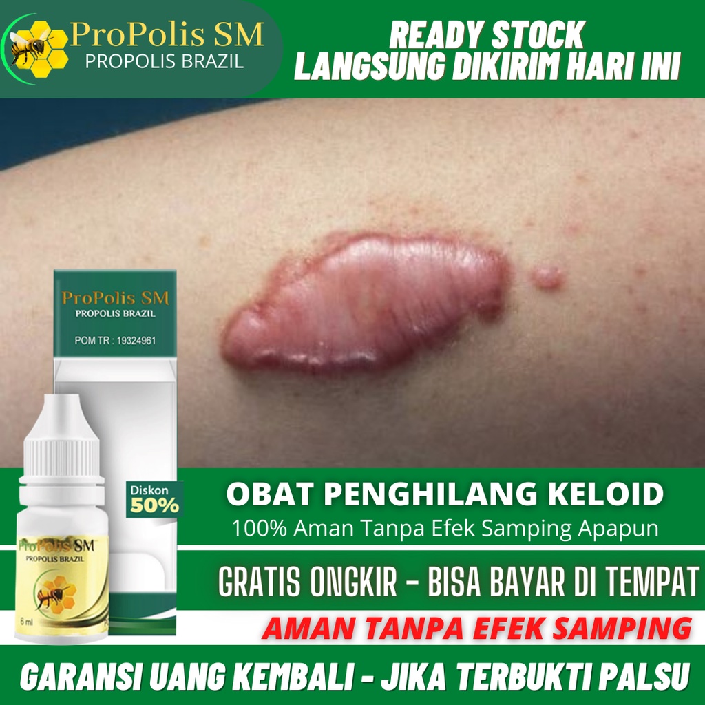 Jual Obat Penghilang Keloid, Obat Keloid Menonjol Tahunan, Obat Keloid ... Jual Obat Penghilang Keloid, Obat Keloid Menonjol Tahunan, Obat Keloid ...