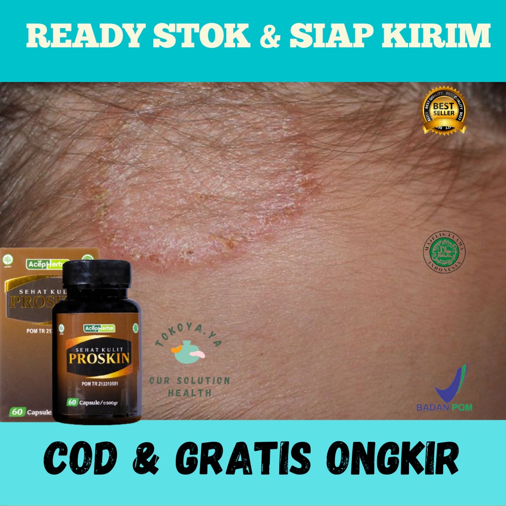 Jual PROSKIN 100% ORIGINAL BPOM, Obat Kulit Gatal Jerawat Ruam Jamur ...