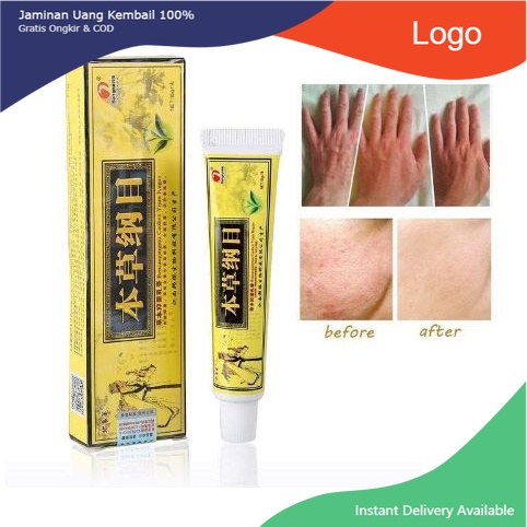 Jual Obat Eksim Salep Gatal Salep Eksim Krim Kulit Psoriasis Dermatitis ...
