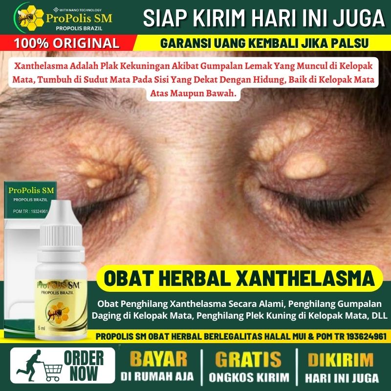 Jual OBAT OLES PENGHILANG GUMPALAN LEMAK KUNING DI KELOPAK MATA - OBAT ...