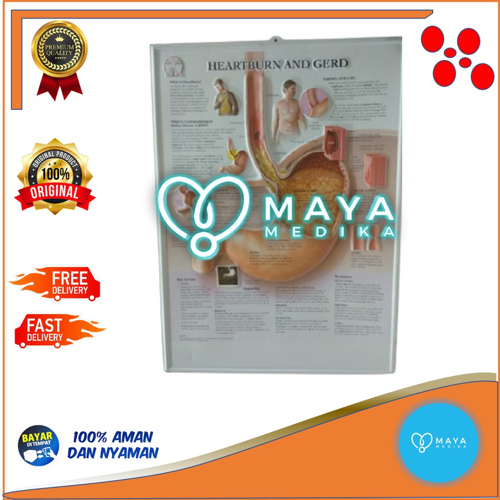 Jual Gambar 3D / Anatomical Chart Heartburn And Gerd | Shopee Indonesia