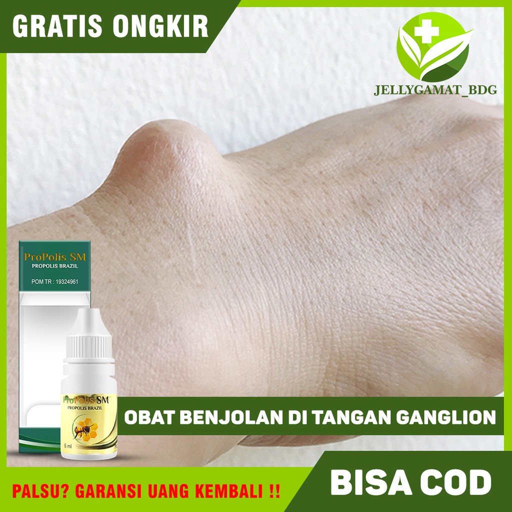 Jual Obat Benjolan Di Tangan, Kista Ganlion, Benjolan Uci Uci, Lipoma ...