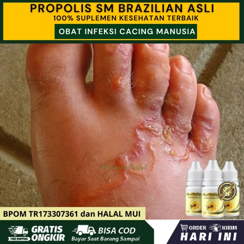 Jual Obat Cacing Kulit Manusia, Cacing Kulit Di Telapak Kaki, Tangan ...