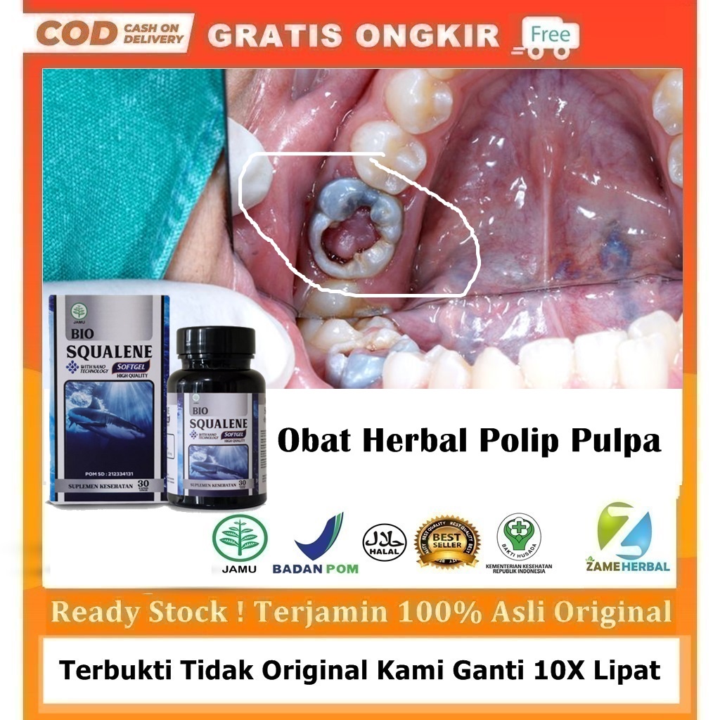 Jual Obat Polip Pulpa di Gigi, Obat Polip Gigi, Obat Polip Pulpa ...