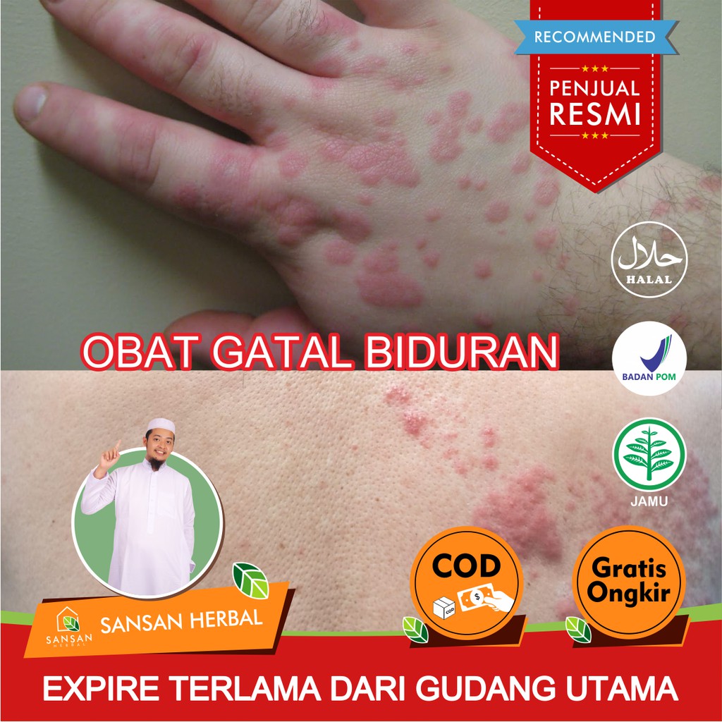 Jual Obat Biduran - Obat Bentol Biduran, Obat Gatal Biduran, Obat ... Jual Obat Biduran - Obat Bentol Biduran, Obat Gatal Biduran, Obat ...