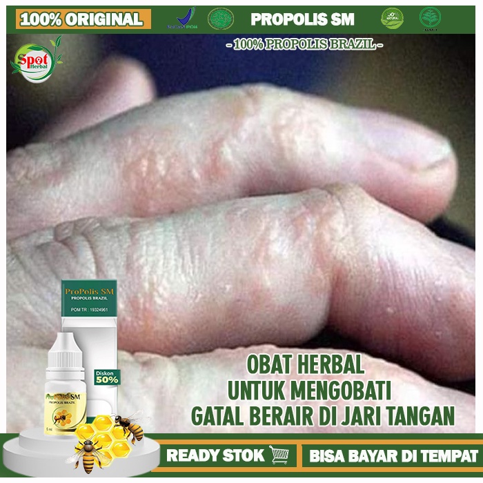 Jual Obat Gatal Berair Di Jari Tangan, Obat Oles Gatal Berair Di Sela ...