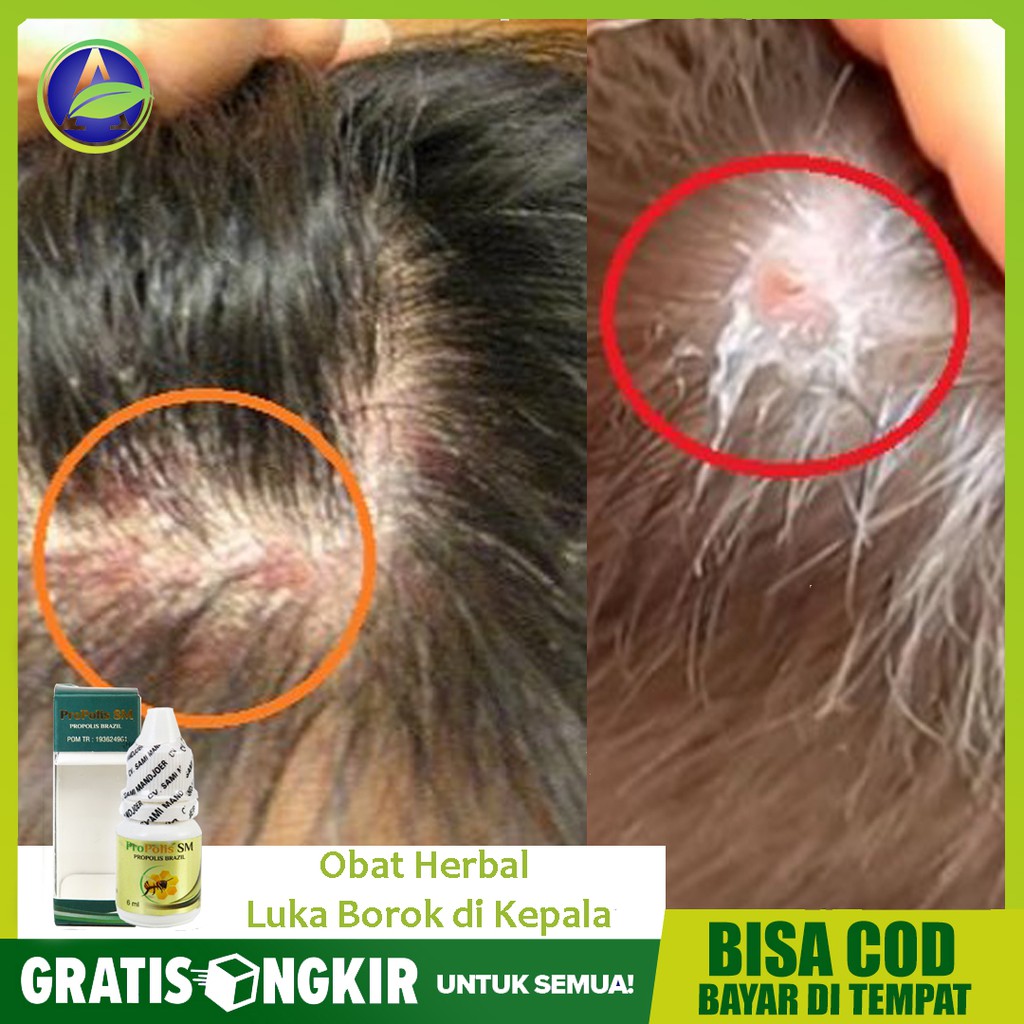 Jual Obat Herbal Luka Borok di Kepala, Borok Bernanah di Kepala Propolis SM Original - Bisa COD ...