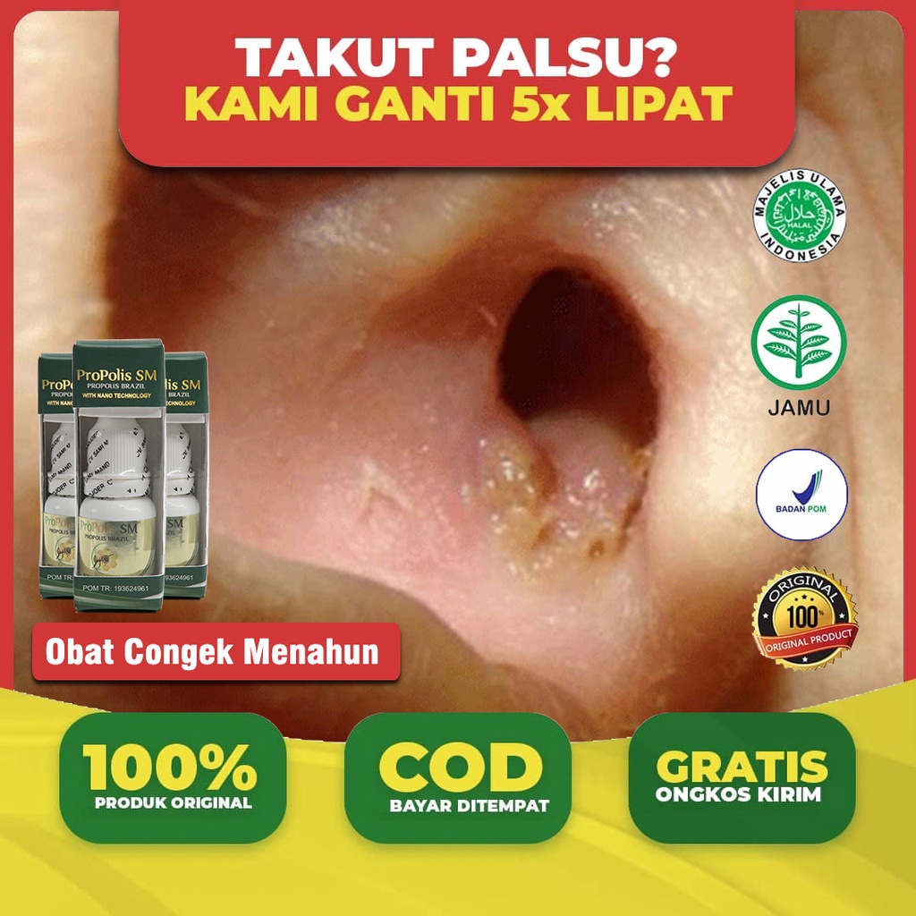 Jual Obat Congek Menahun - Telinga Bernanah - Telinga Cenang - Telinga ...