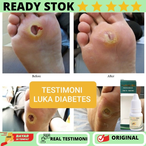 Jual Obat Pengering Luka Diabetes, Obat Luka Diabetes Basah, Obat Luka ...