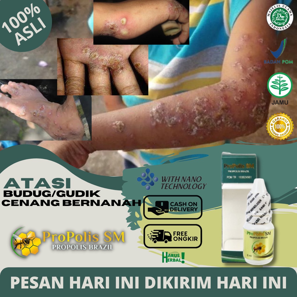 Jual Obat Tetes Budug Bernanah, Obat Cenang Bernanah, Luka Bernanah ...