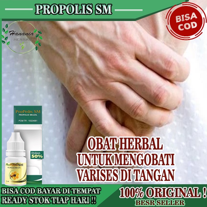 Jual Obat Varises Di Tangan, Urat Tangan Menonjol, Varises Di Tungkai ...
