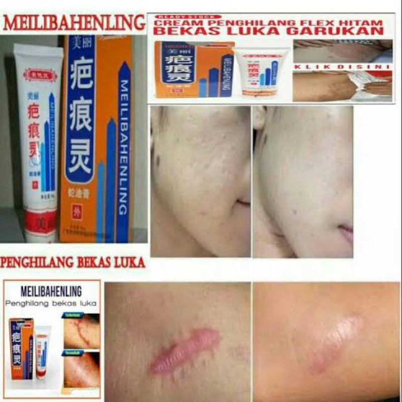 Jual salep meilibahenling original salep penghilang bekas luka jahitan ...