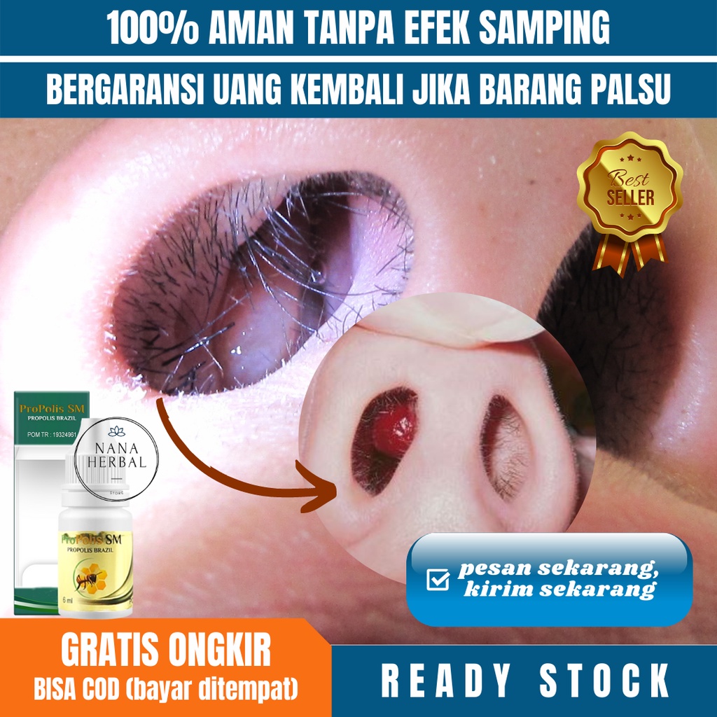 Jual Obat Benjolan Polip Hidung, Obat Sinusitis, Benjolan Di Dalam Hidung, Obat Hidung Mampet ...
