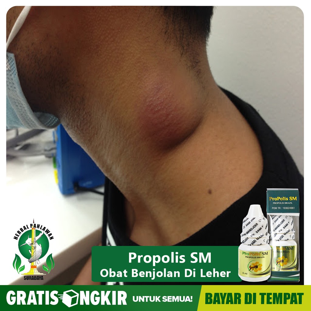 Jual Obat Benjolan Di Leher dan kepala di ketiak benjolan betah bening ...