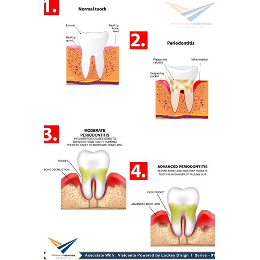 Jual POSTER GIGI PERIODONTIS CASE | Shopee Indonesia